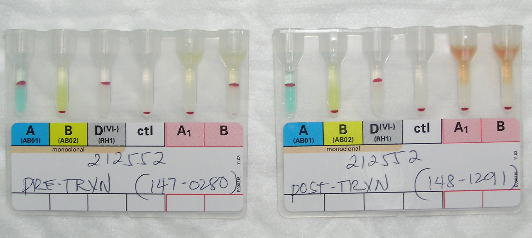 Clinical Significance of a Negative DAT – Dr. Zeyd Merenkov